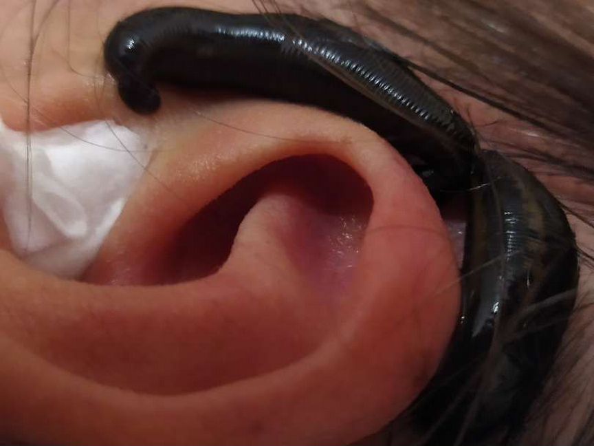 Пиявки гирудоtерапия